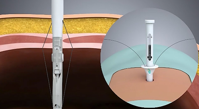 Disposable Endo Fascia Closure System - Buy Disposable Endo Fascia ...